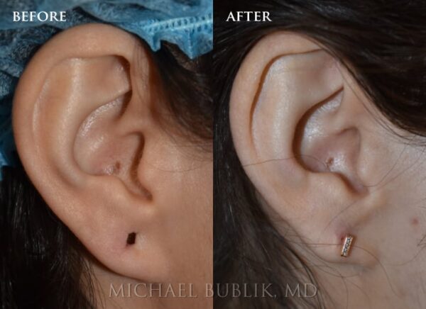 Ear Lobe Repair in Los Angeles & Glendale- Dr. Michael Bublik