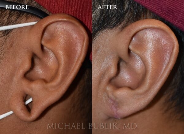 Ear Lobe Repair in Los Angeles & Glendale- Dr. Michael Bublik