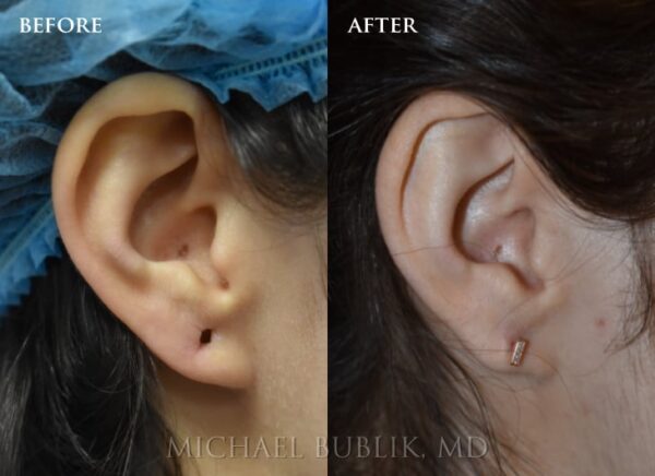 Ear Lobe Repair in Los Angeles & Glendale- Dr. Michael Bublik