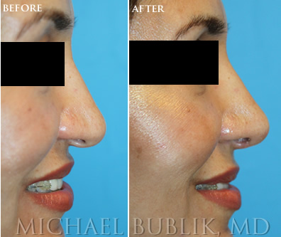 Nasal Tip Surgery for Droopy Tip in Los Angeles & Glendale - Dr ...