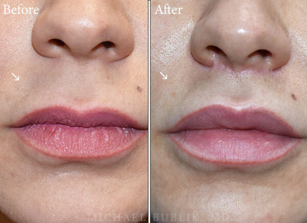 Surgical Lip Lift in Los Angeles & Glendale - Dr. Michael Bublik