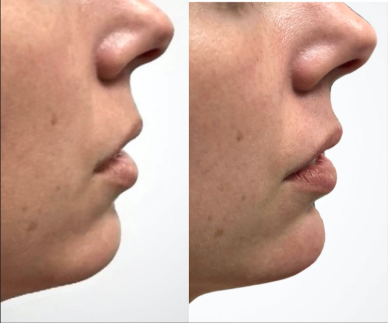 Chin & Jaw Line Fillers in Los Angeles & Glendale - Dr. Michael Bublik